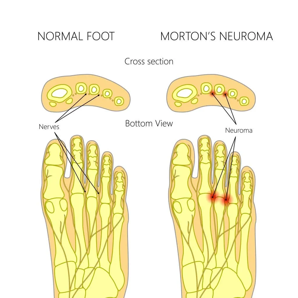 Blog 14 - Morton’s Neuroma: Causes, Symptoms, and Treatment
