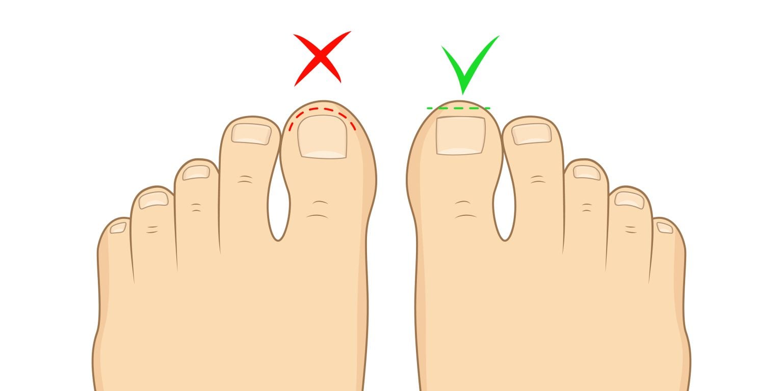 Is The Surgical Procedure For Ingrown Toenail Painful? How Long Does It ...