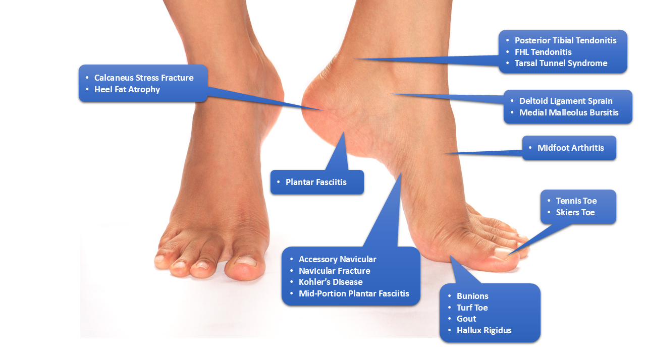 Sudden Foot Pain Without Injury? Possible Causes & Evidence-Based ...